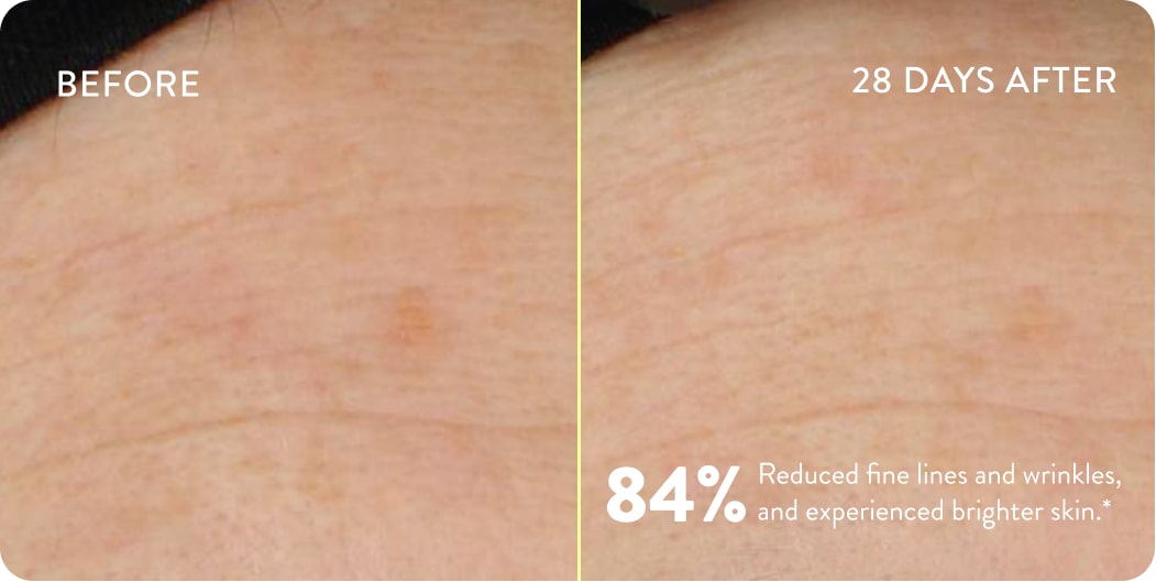 Customized skincare for hyperpigmentation